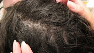 dandruff - The London Dermatologist