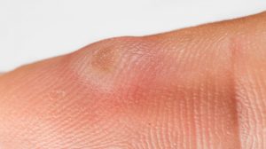 Warts and Veruccas - The London Dermatologist