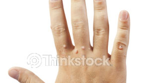 wart - The London Dermatologist